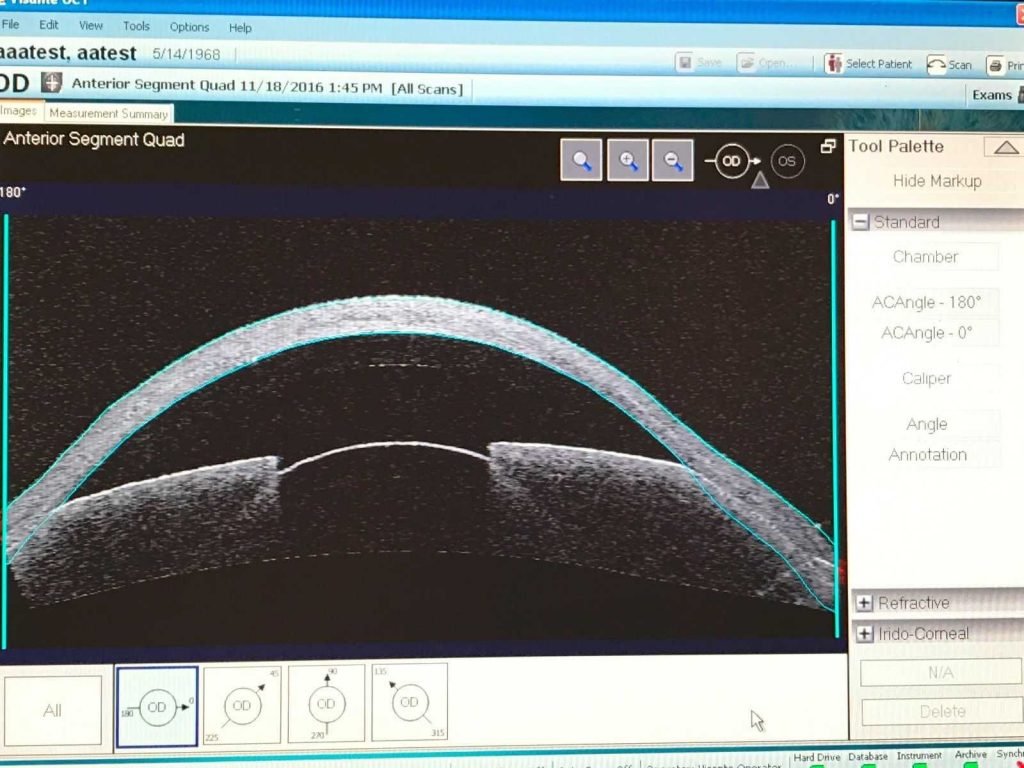 Carl Zeiss Visante OCT Anterior Segment Imaging and Biometry - Nava ...