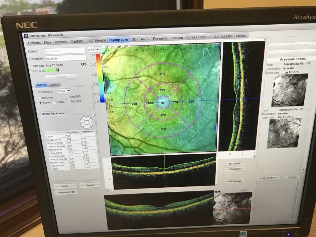Optos OCT SLO Retina Glaucoma Cornea Analysis - Nava Ophthalmic