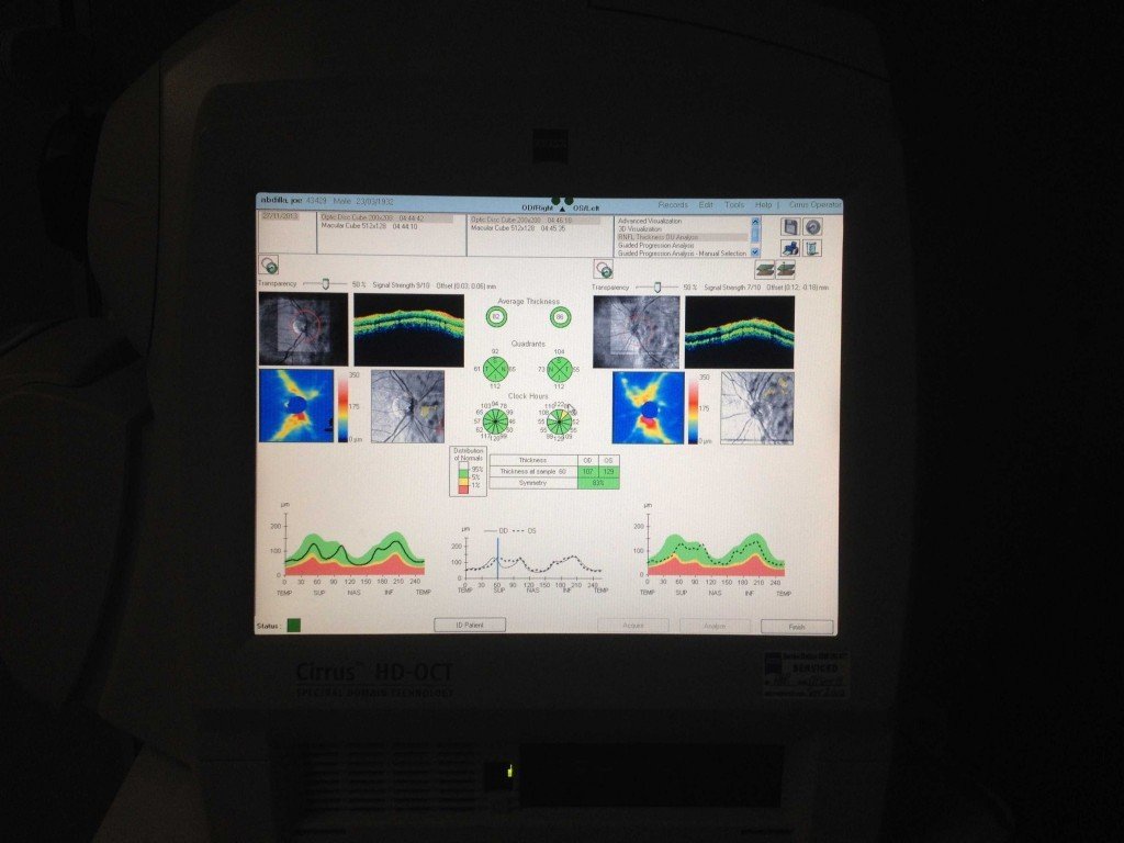 Heidelberg Spectralis HRA + OCT - Nava Ophthalmic