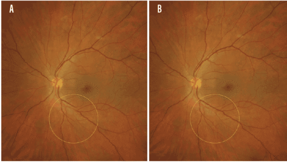 Zeiss Clarus 700 Ultra widefield Fundus Imaging | Nava Ophthalmic