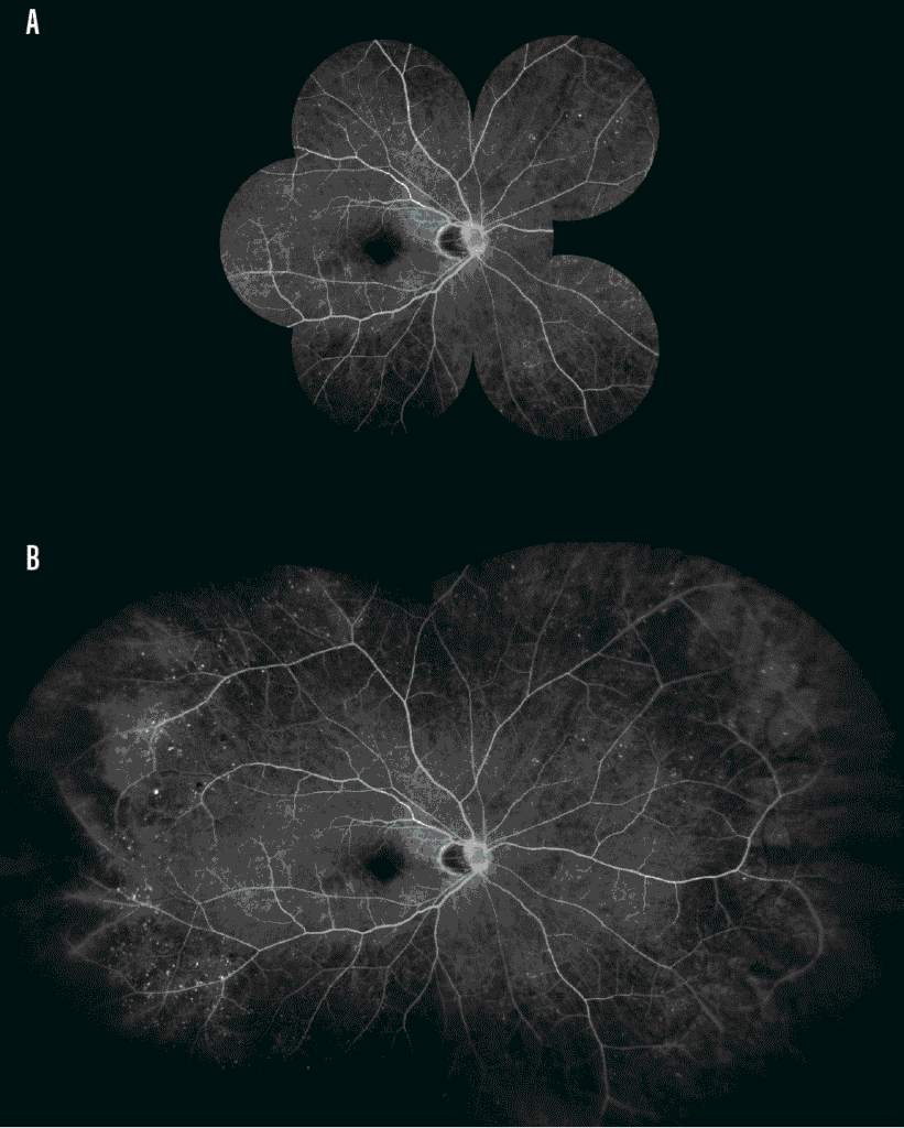 Zeiss Clarus 700 Ultra widefield Fundus Imaging | Nava Ophthalmic